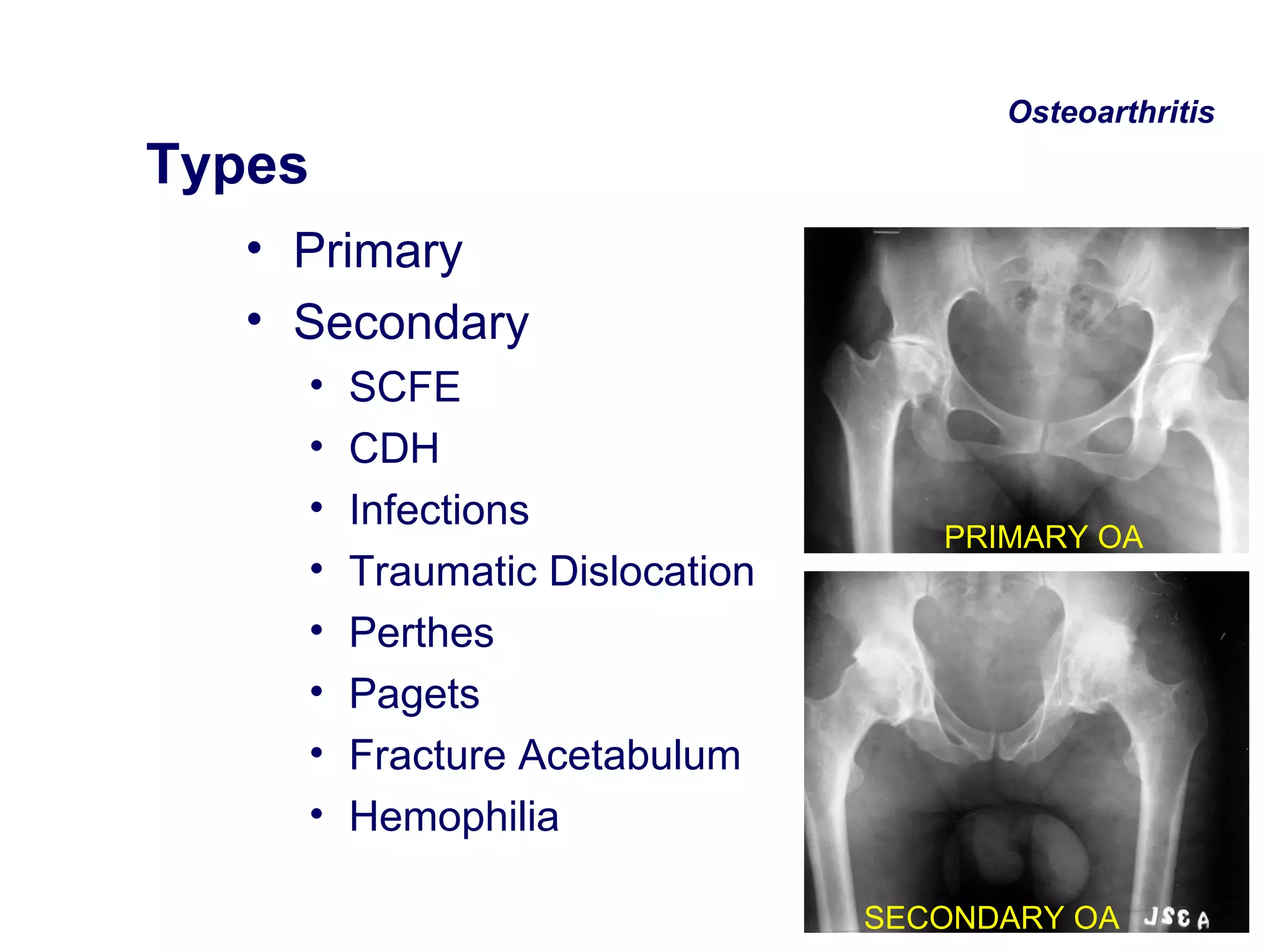 Approach To A Patient With Polyarthritis | PPT