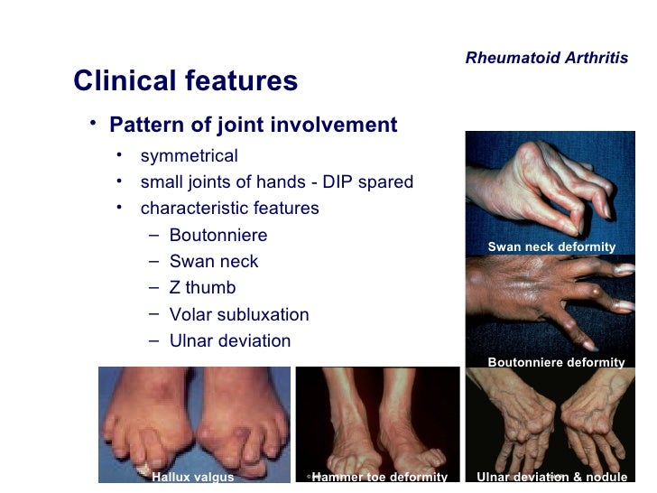 Approach To A Patient With Polyarthritis