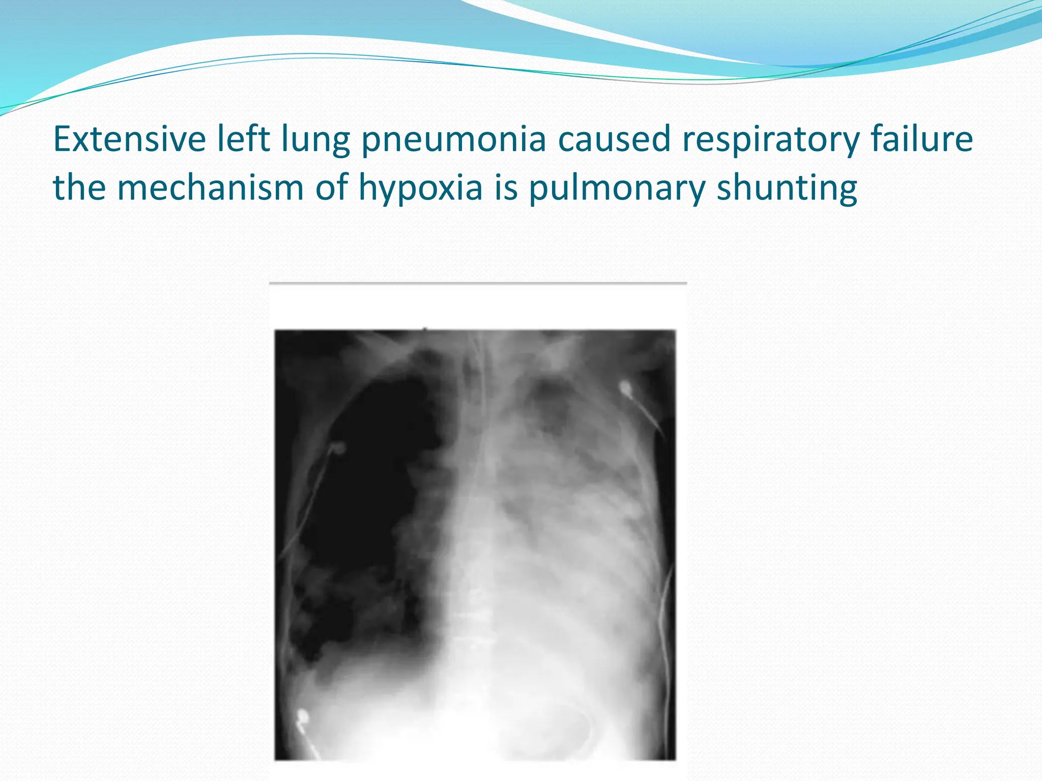 APPROACH TO A PATIENT WITH RESPIRATORY FAILURE.pptx