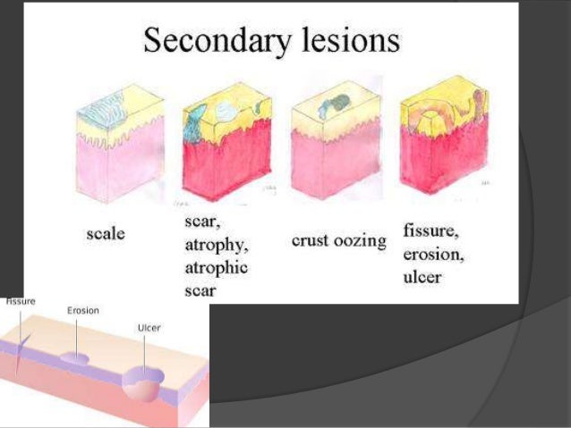 Excoriation Histology