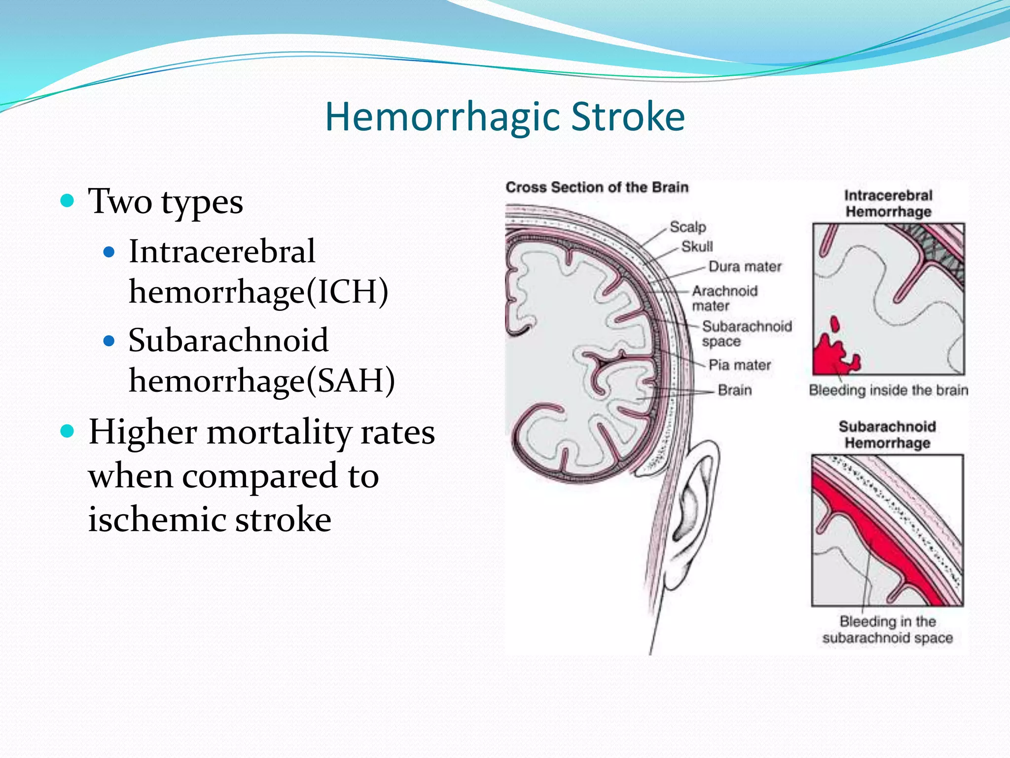 Approach to a patient with stroke - Pathophysiology of stroke | PPTX