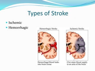 Approach to a patient with stroke - Pathophysiology of stroke | PPTX