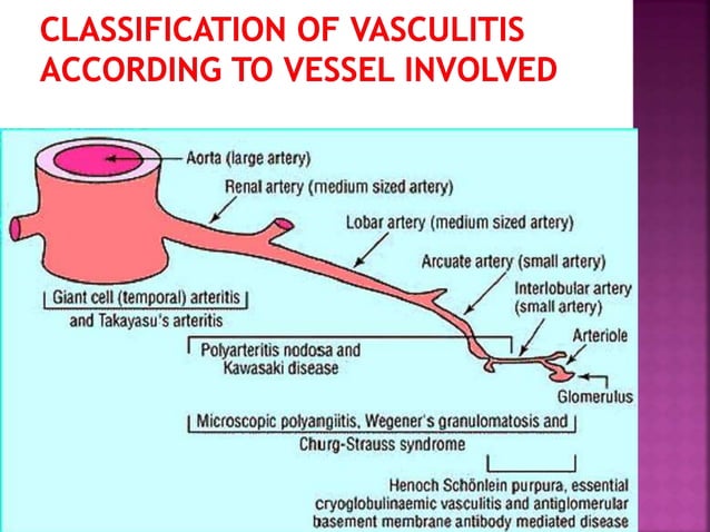 Approach to a patient with vasculitis and its | PPTX