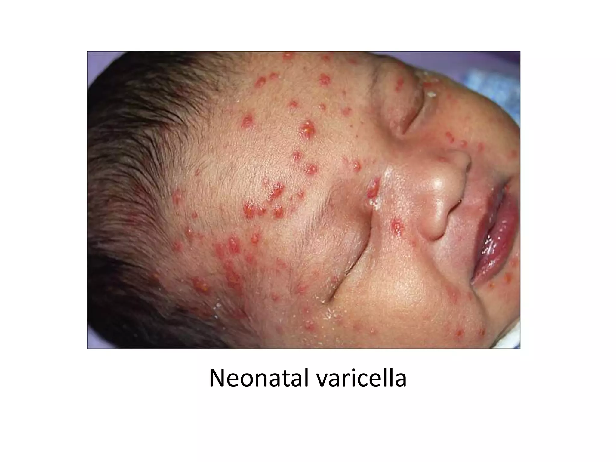 Approach to a patient with vesicobullous lesions | PPTX