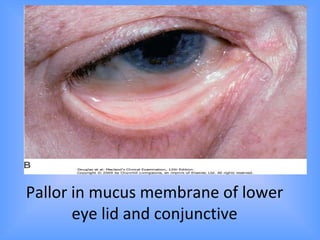 Approach to a pationt with pallor | PPT