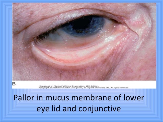 Approach to a pationt with pallor