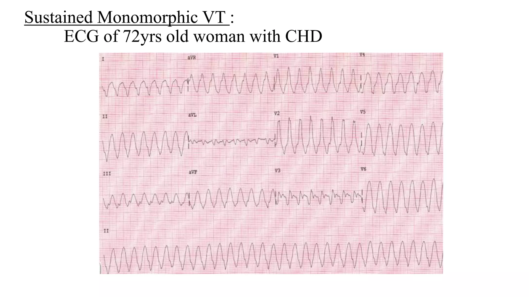 Approach to cardiac arrhythmias | PPTX