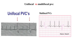 Approach to cardiac arrhythmias | PPT