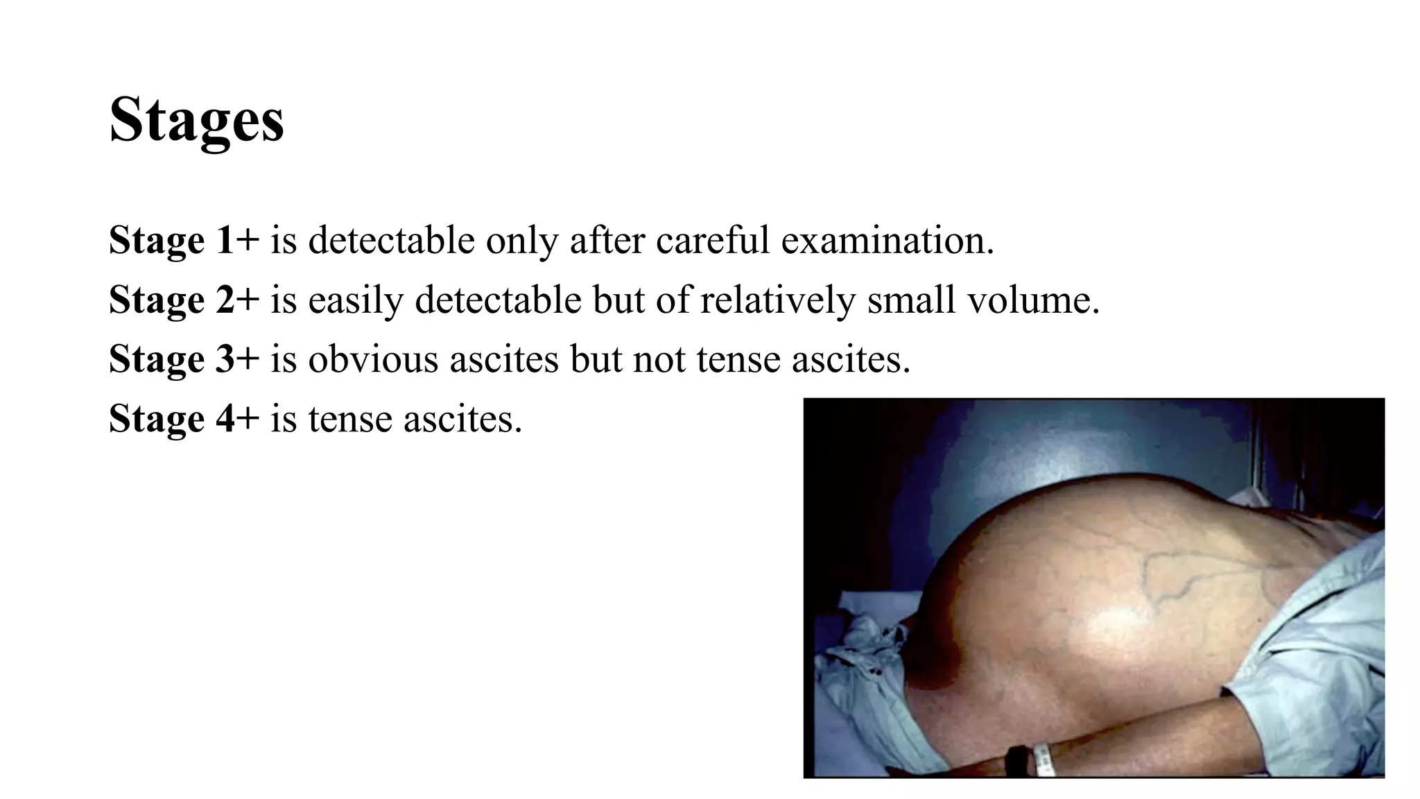Approach to ascites | PDF