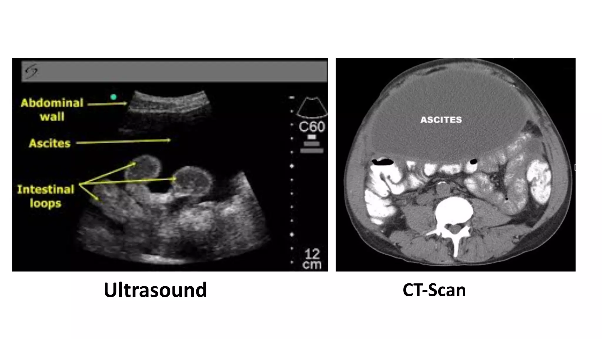 Approach to ascites | PDF