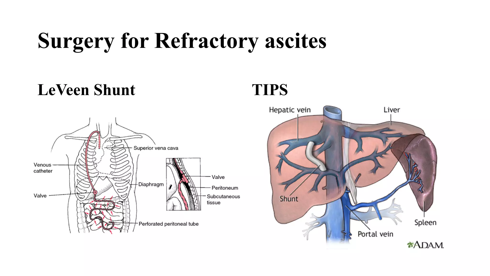 Approach to ascites | PDF