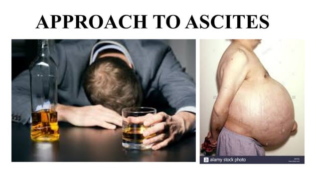 Approach to ascites | PDF | Blood Disorders | Diseases and Conditions