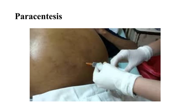 Approach to ascites | PDF | Blood Disorders | Diseases and Conditions