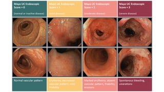 Approach to ASUC- Diagnosis and management | PPTX
