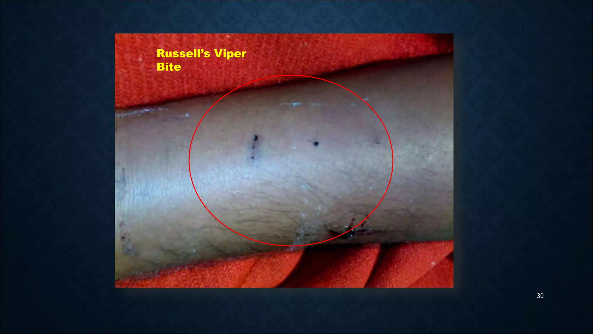 Approach to a victim of snake bite | PPSX