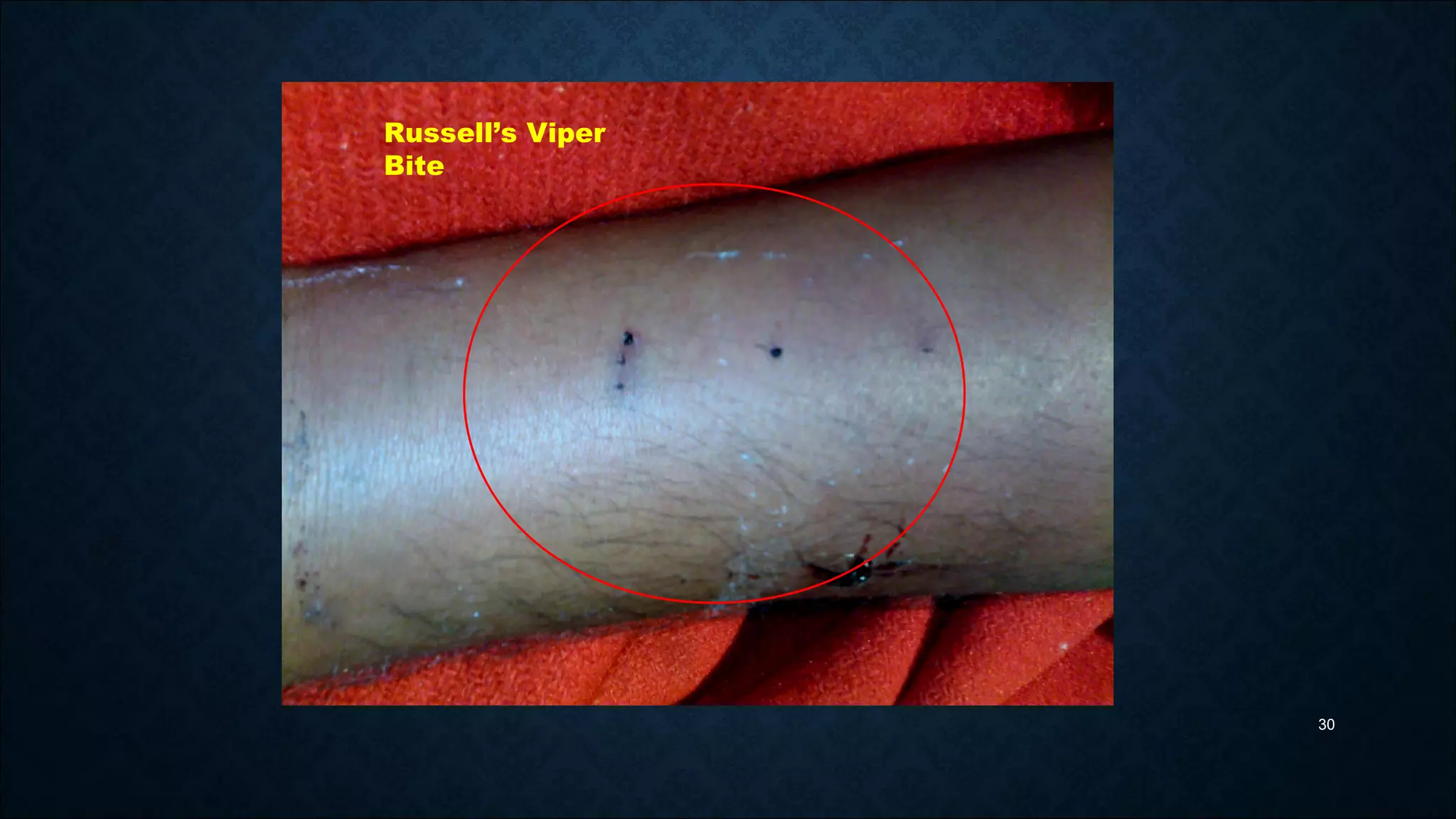 Approach to a victim of snake bite | PPT