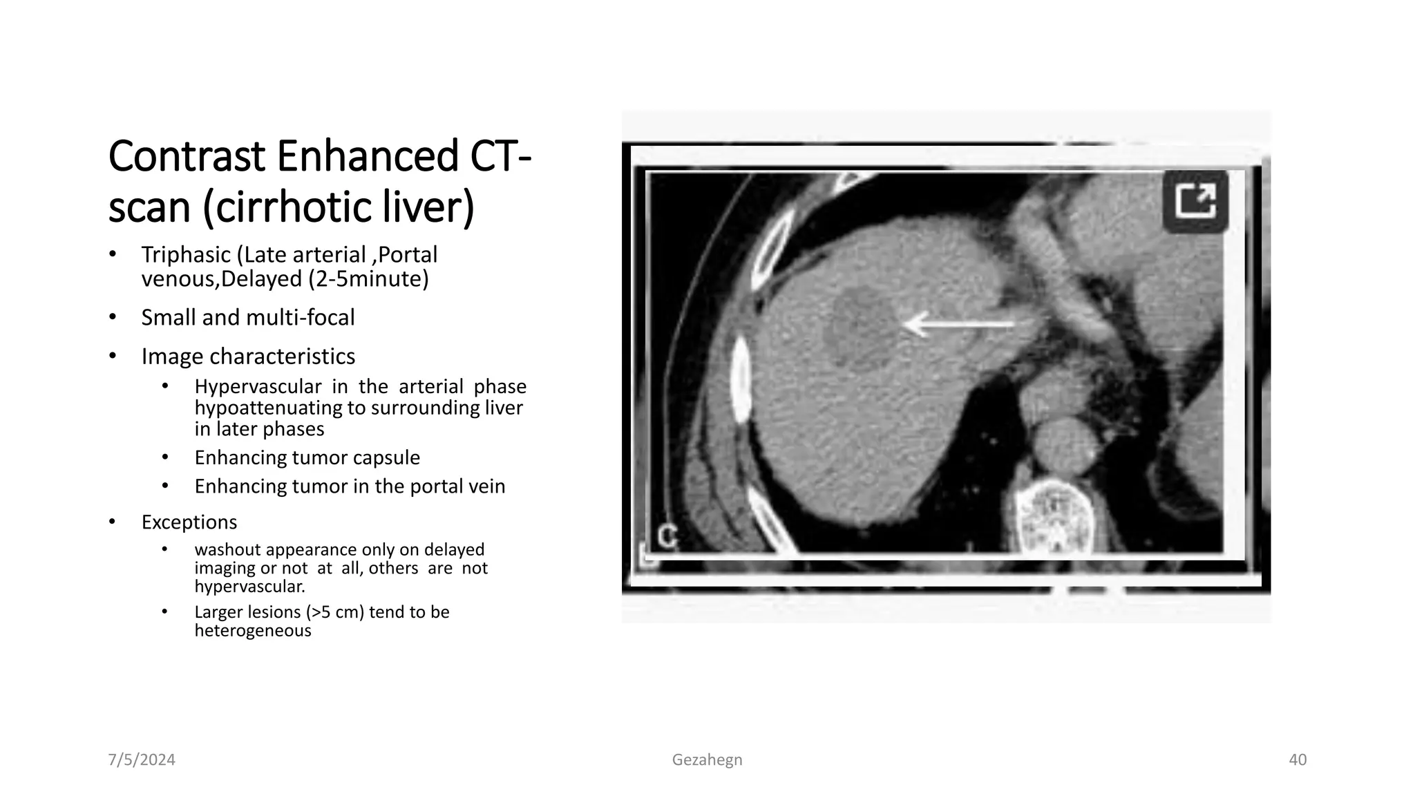 Approach to Benign and Malignant lesion of the liver.pptx