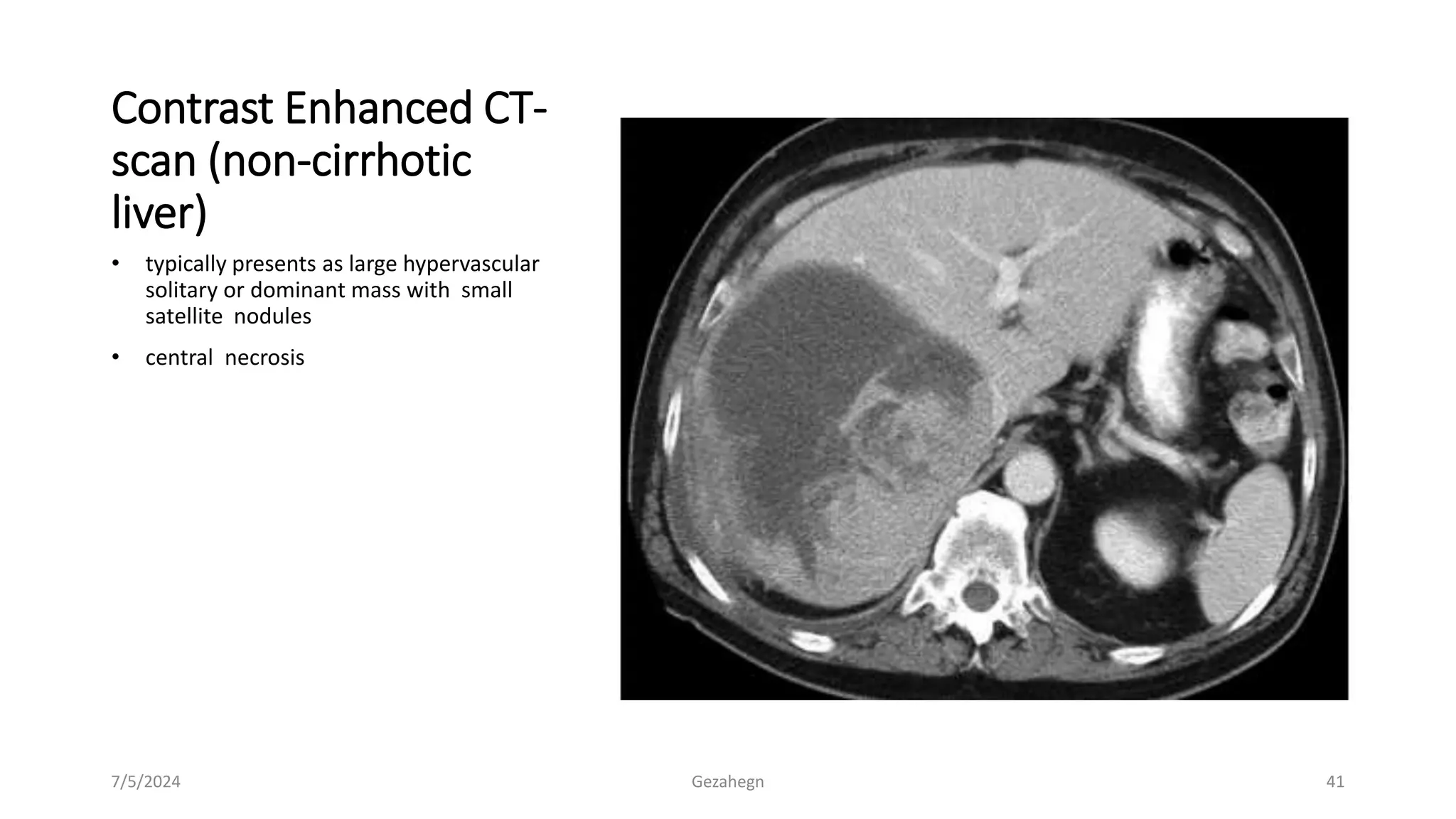 Approach to Benign and Malignant lesion of the liver.pptx