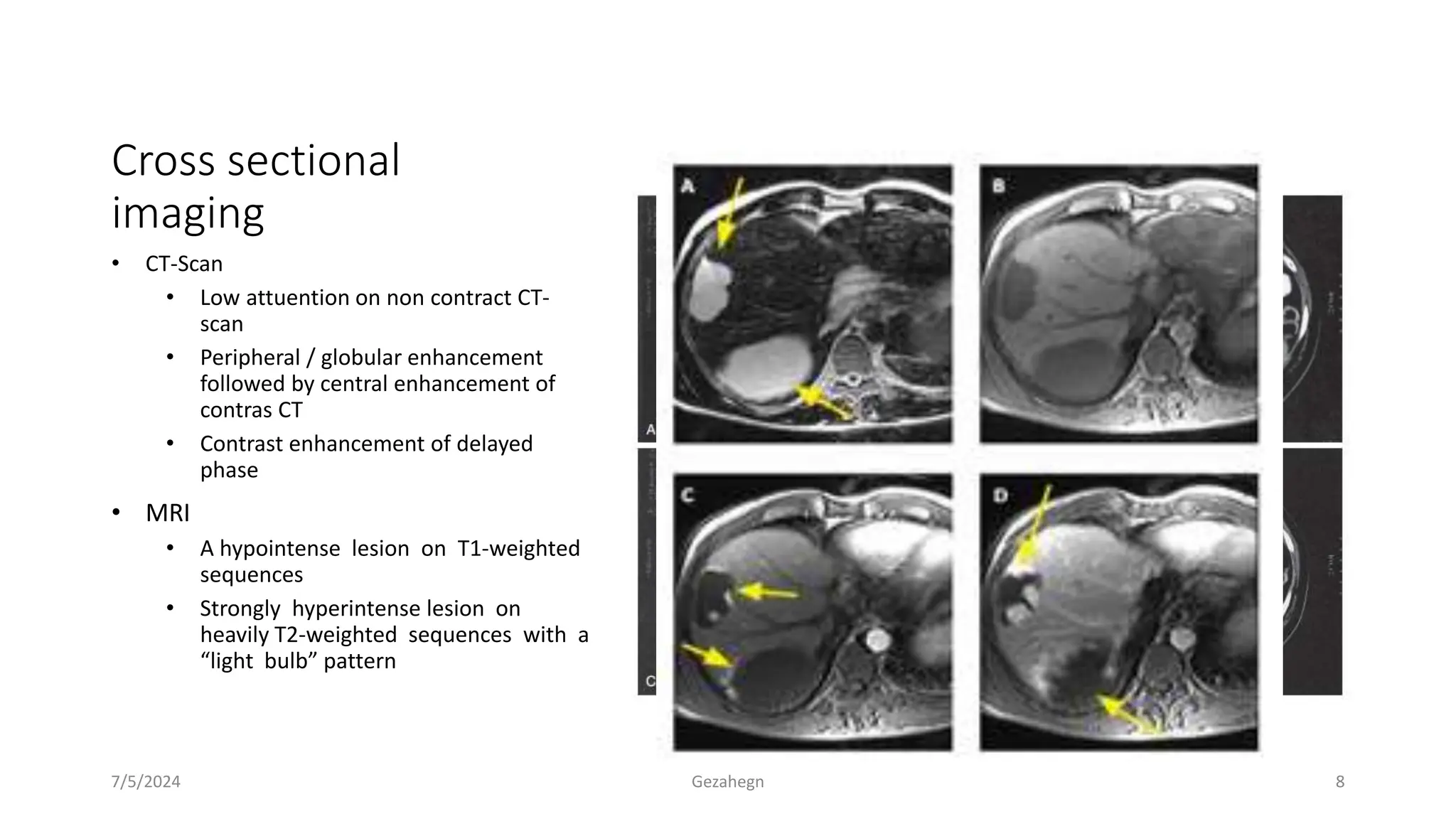 Approach to Benign and Malignant lesion of the liver.pptx