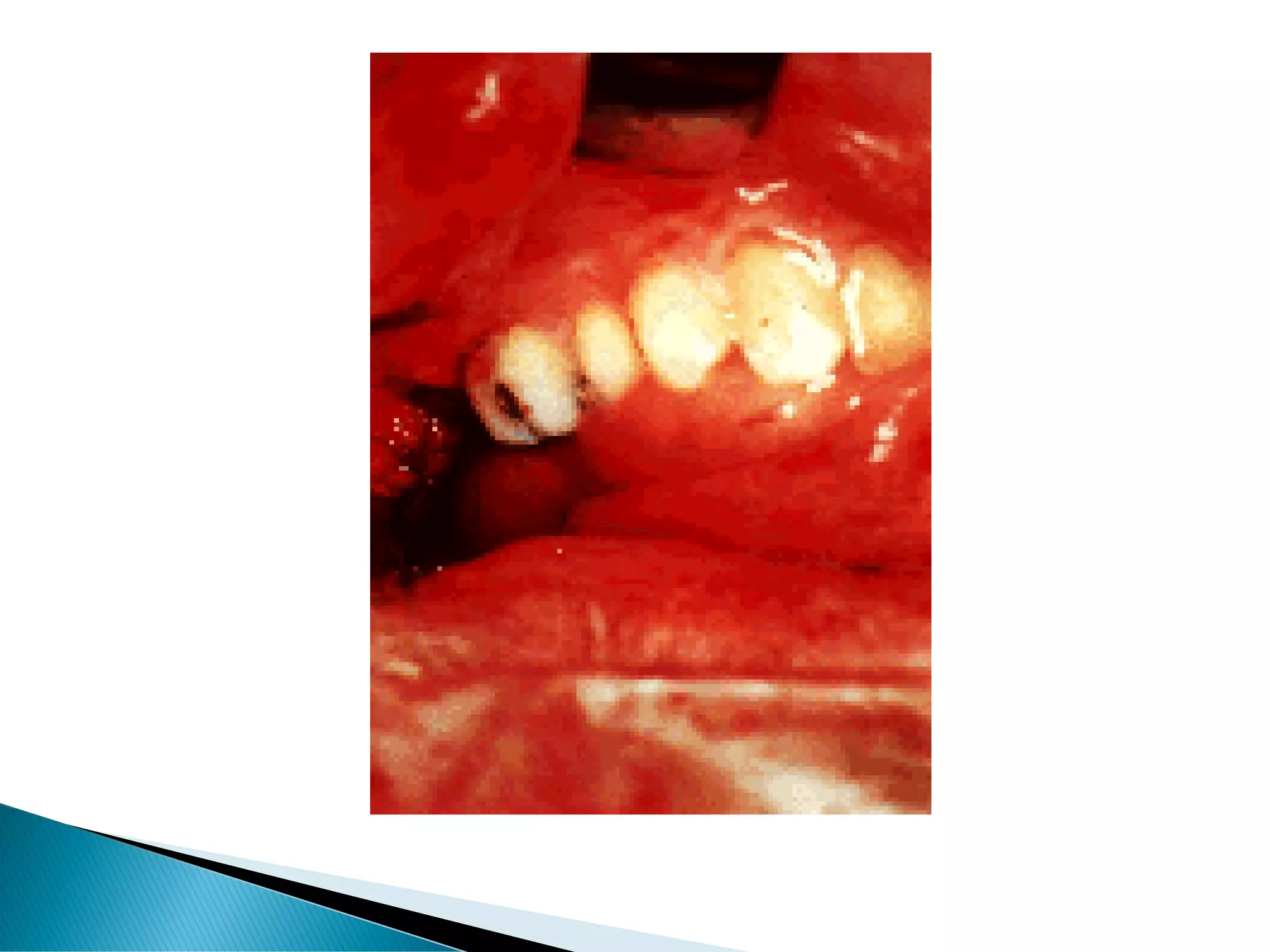 Approach to bleeding child | PDF
