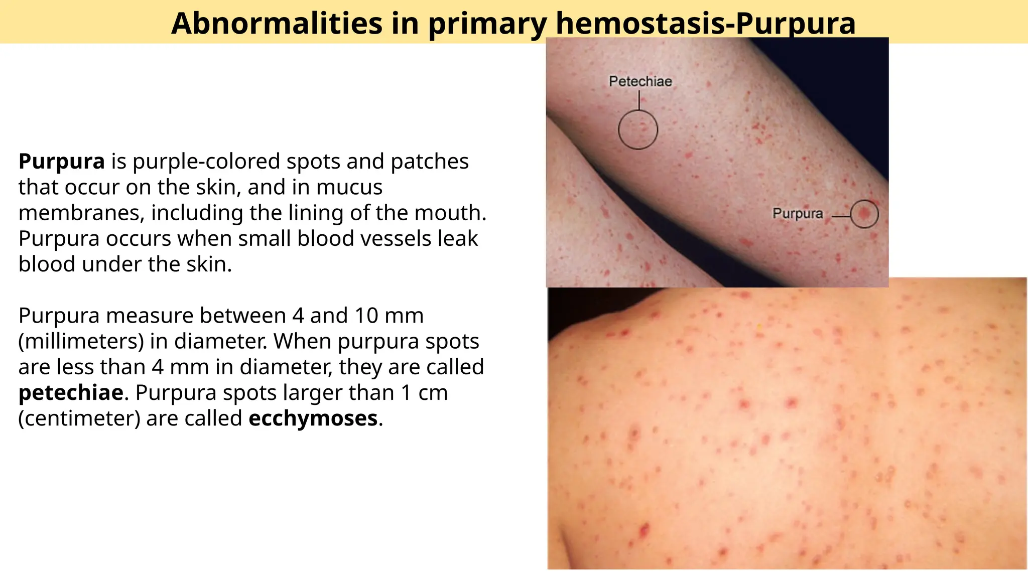Approach to Bleeding Disorder Hematopathology | PPTX
