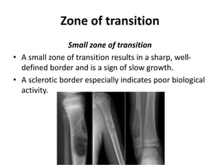 Approach to bone tumor | PPTX