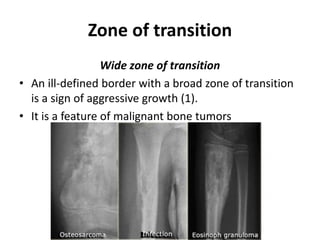Approach to bone tumor | PPTX