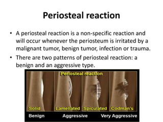 Approach to bone tumor | PPTX
