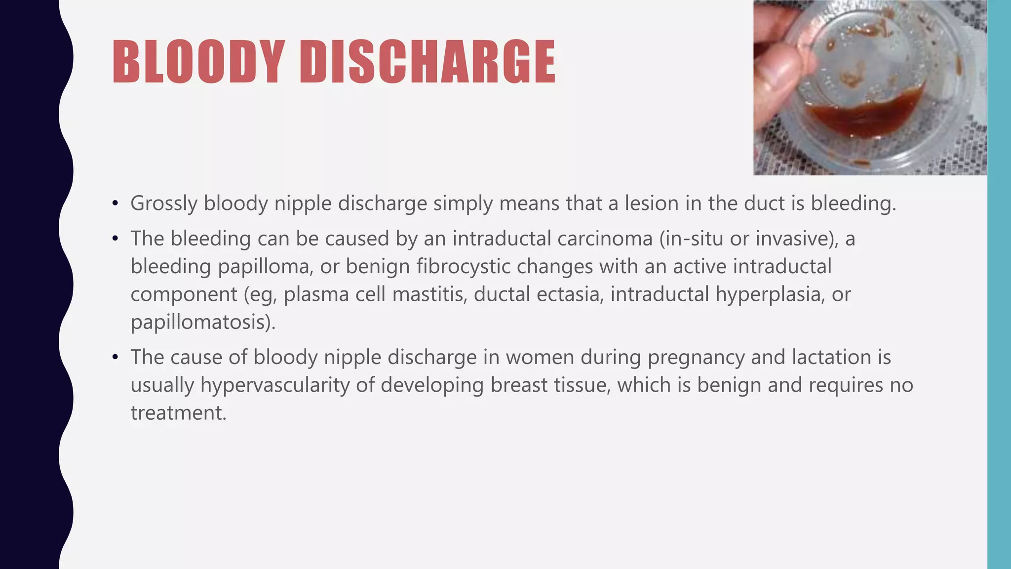Approach to breast lump pain, nipple discharge | PPT