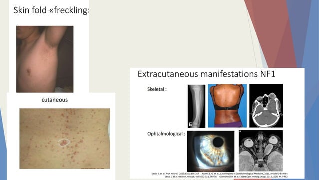 Approach to Cafe au lait spots in children | PPTX | Brain and Nervous ...