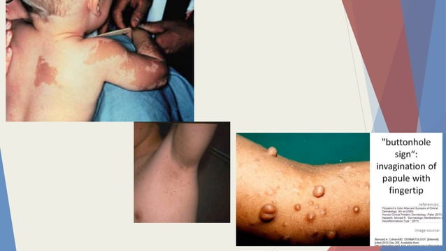 Approach to Cafe au lait spots in children | PPTX | Brain and Nervous ...