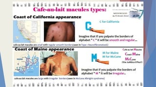 Cafe Au Lait Spots Mccune Albright Syndrome