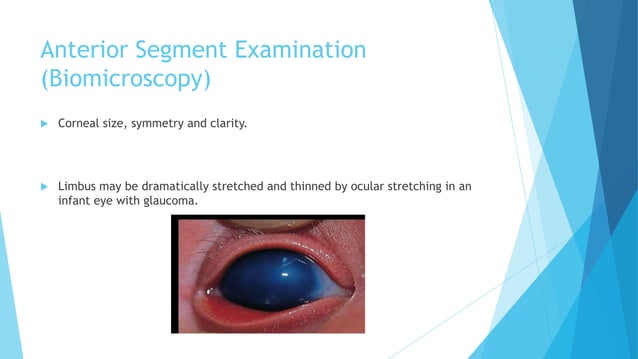 Approach to cases of congenital glaucoma, developmental | PPTX
