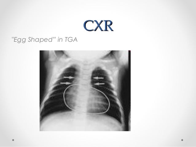Congenital Heart Disease