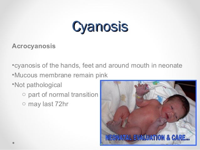Congenital Heart Disease