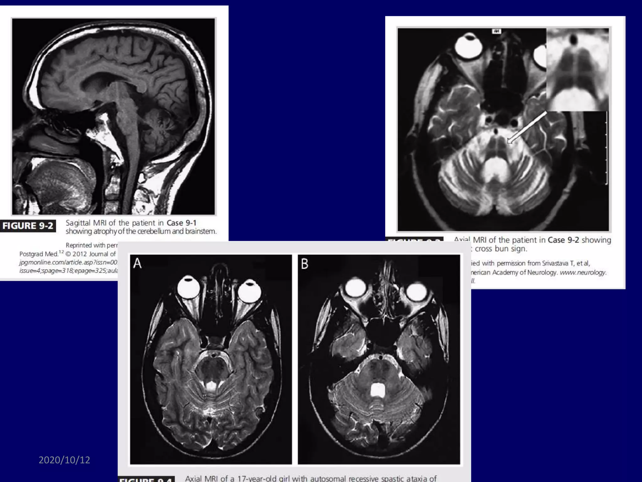 Approach to cerebellar ataxia | PPT