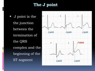Approach to chest pain | PPTX