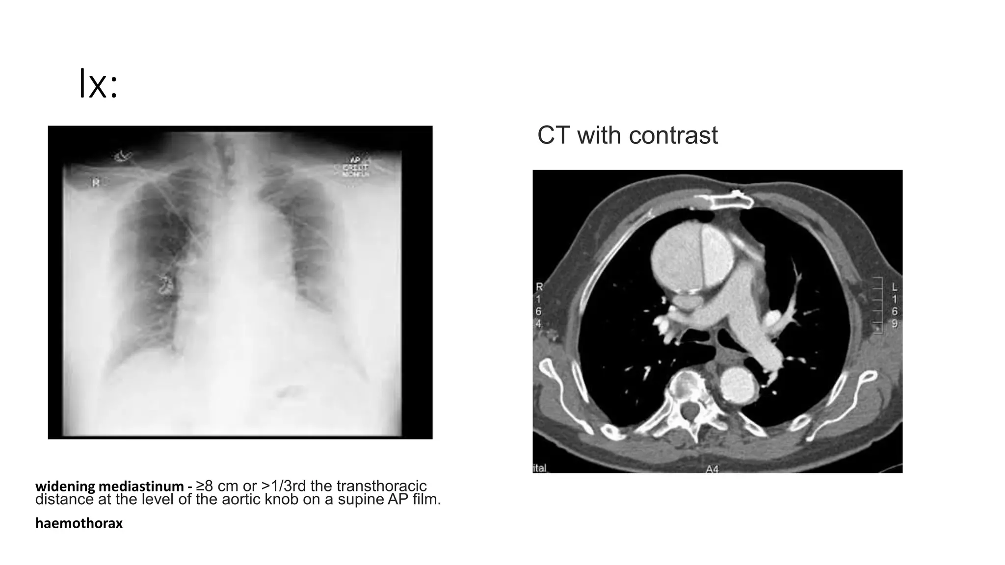 Approach to chest pain | PPTX