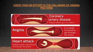 Approach to chest pain | PPTX