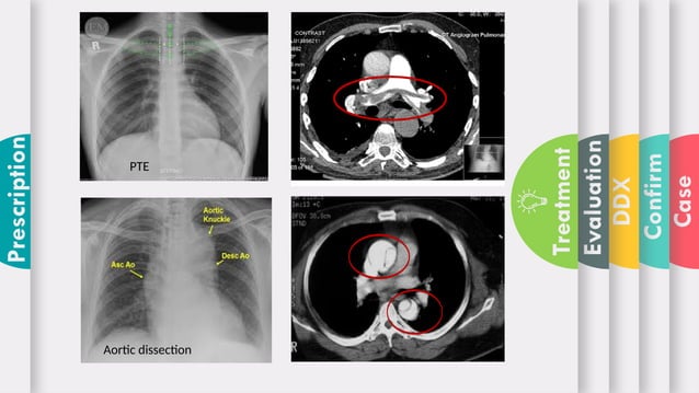 Approach to Chest pain in cardiology .pptx