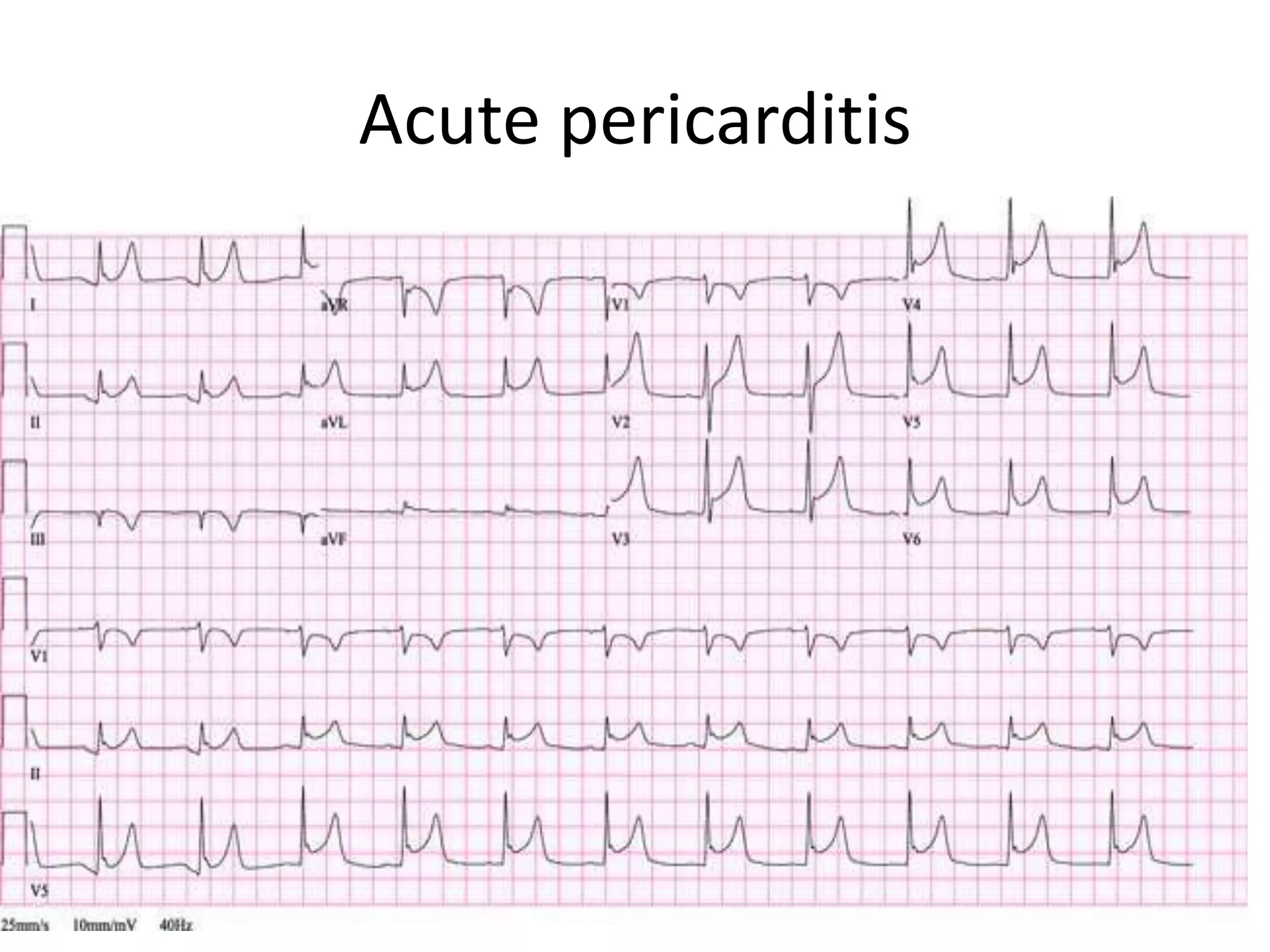 Approach to chest pain, case- based and pericarditis guidelines Ahmed ...