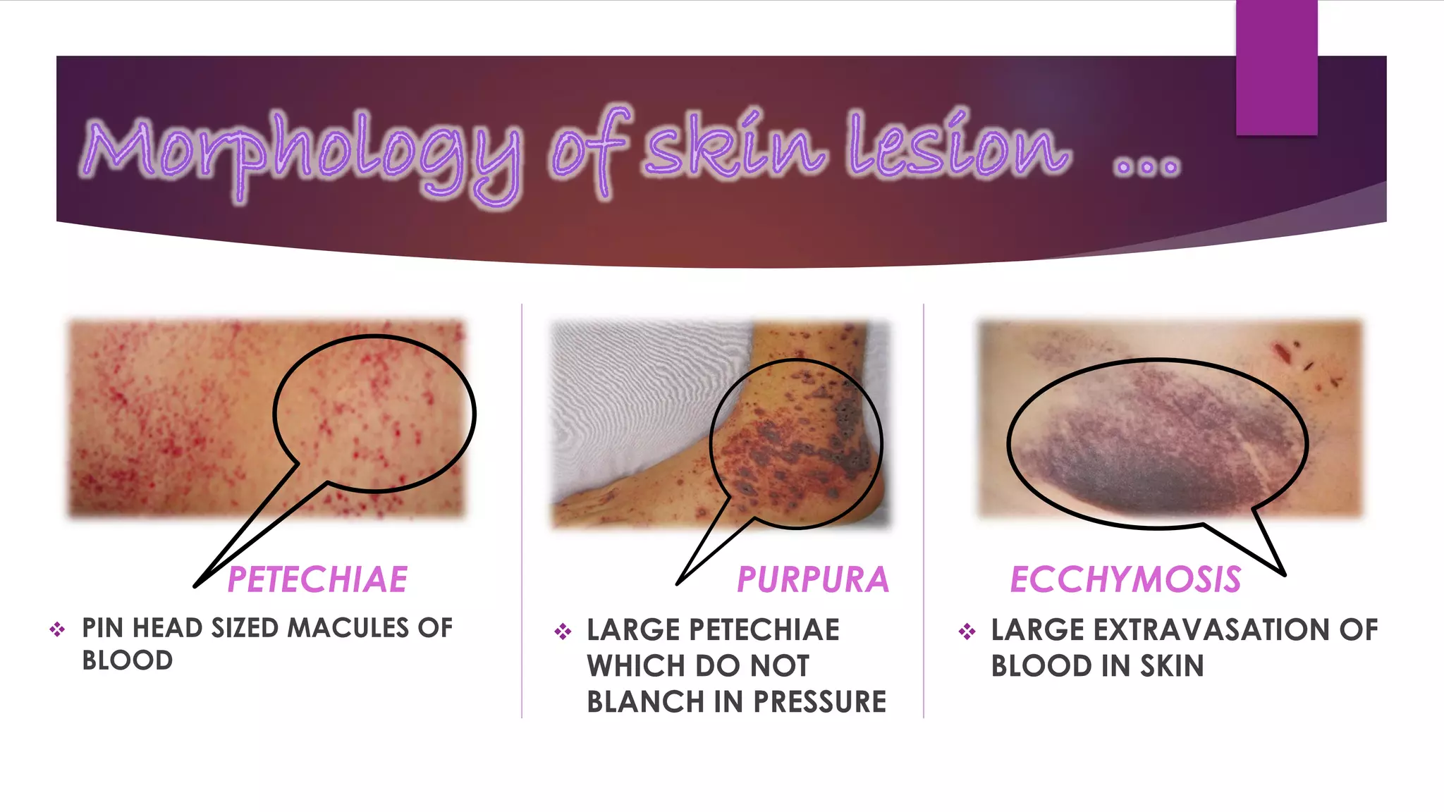 Approach to child – fever with rash | PDF