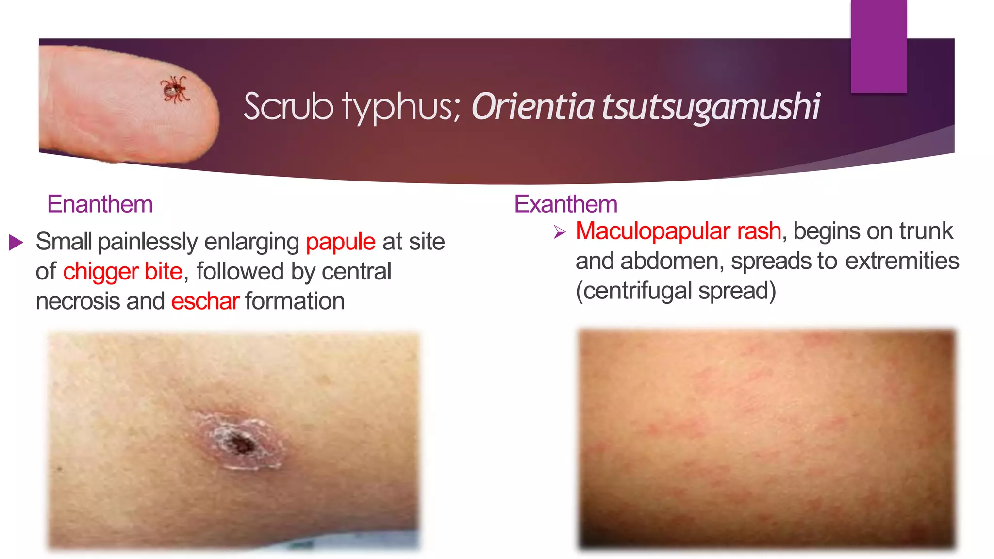 Approach to child – fever with rash | PDF