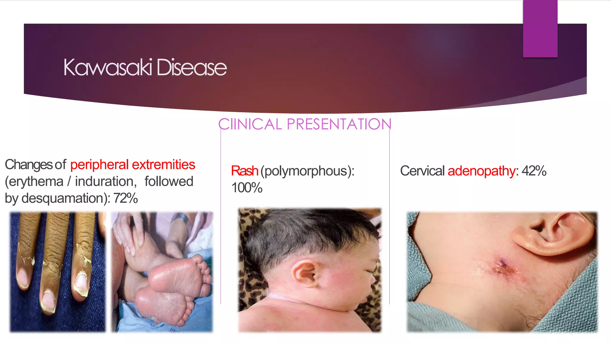 Approach to child – fever with rash | PDF