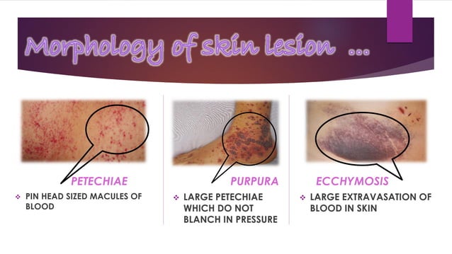 Approach to child – fever with rash | PDF