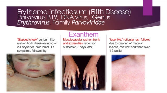 Approach to child – fever with rash | PDF