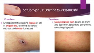 Approach to child – fever with rash | PDF