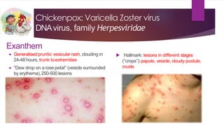 Approach to child – fever with rash | PDF