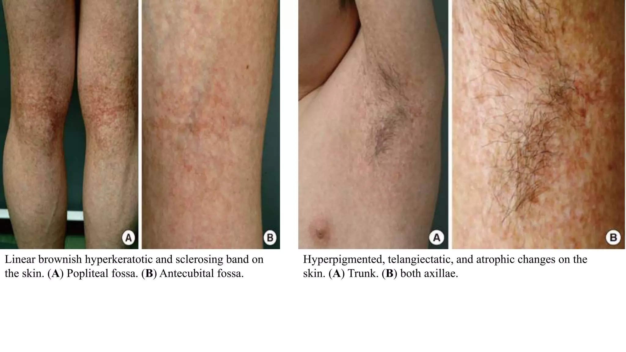 Approach to childhood poikiloderma.pptx