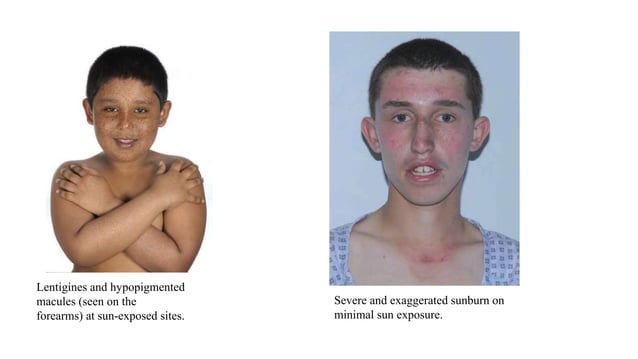 Approach to childhood poikiloderma.pptx